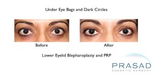 Platelet-Rich Plasma (PRP) for Tear Troughs, Dark Circles & Eye bags