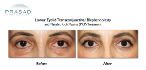 Platelet-Rich Plasma (PRP) for Tear Troughs, Dark Circles & Eye bags